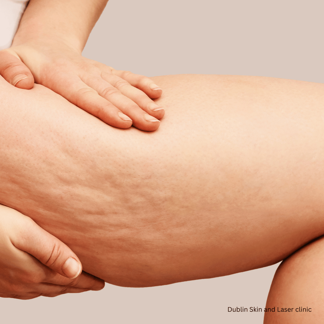 Cellulite – Dublin Skin & Laser Clinic
